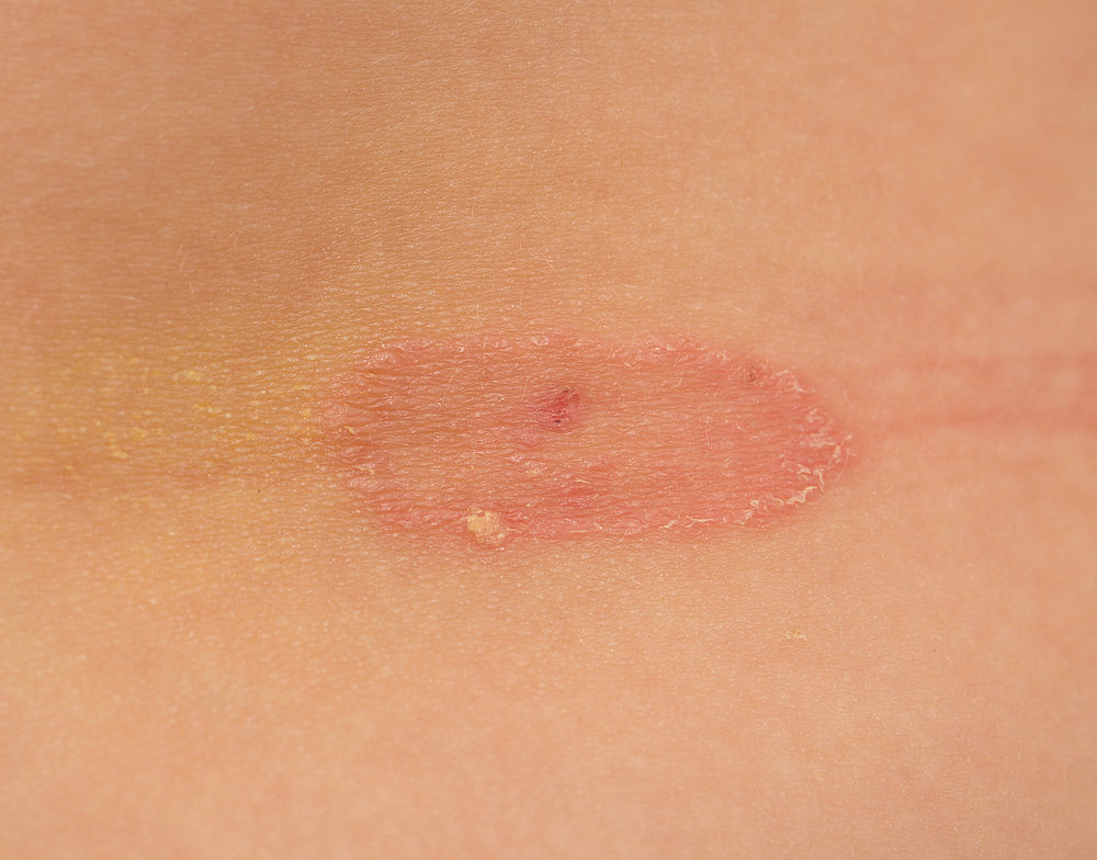 Ringworm | Clear Up These Common Children's Skin Conditions | POPSUGAR Moms